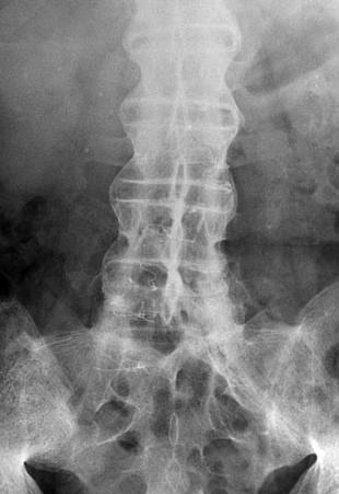 Morbus Bechterew - Symptomer, behandling, arvelighed osv.